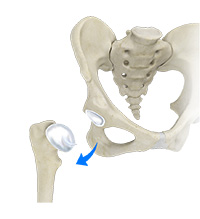 Hip Dislocation | Northwest Orthopaedic Surgery